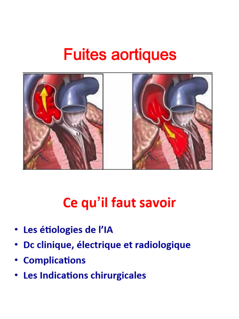 Insuffisance Aortique et Syndromes Associés | PDF