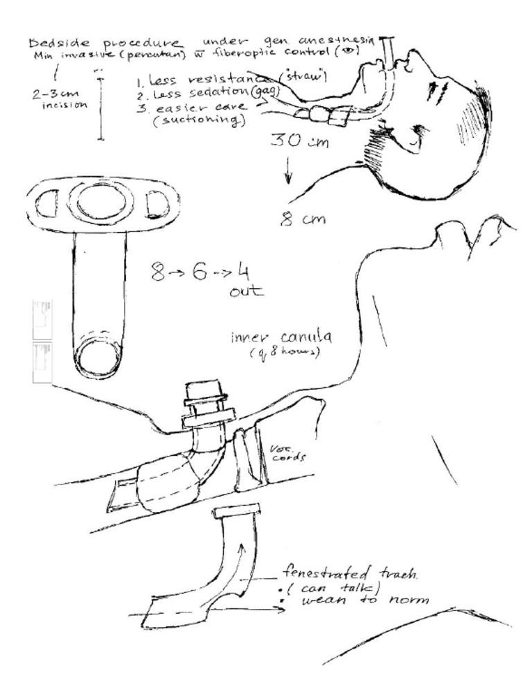 Tracheostomy Diagram | PDF