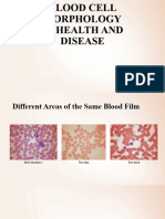Pencil Cells in Iron Deficiency Anemia | PDF | Anemia | Hematology