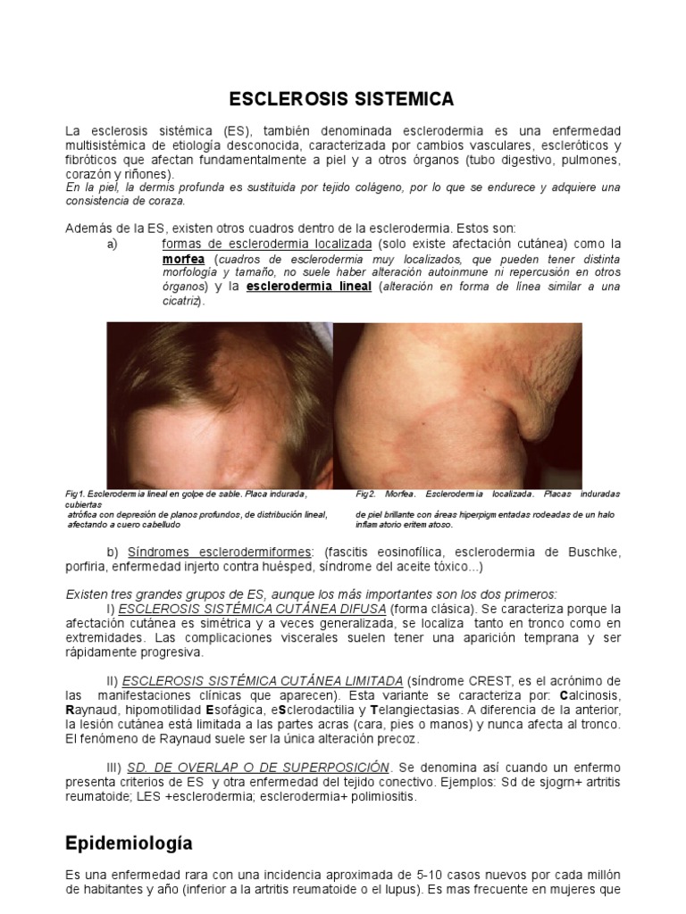 Esclerodermia(4 Dic 06)Eva | Lupus eritematoso sistémico | Enfermedades ...