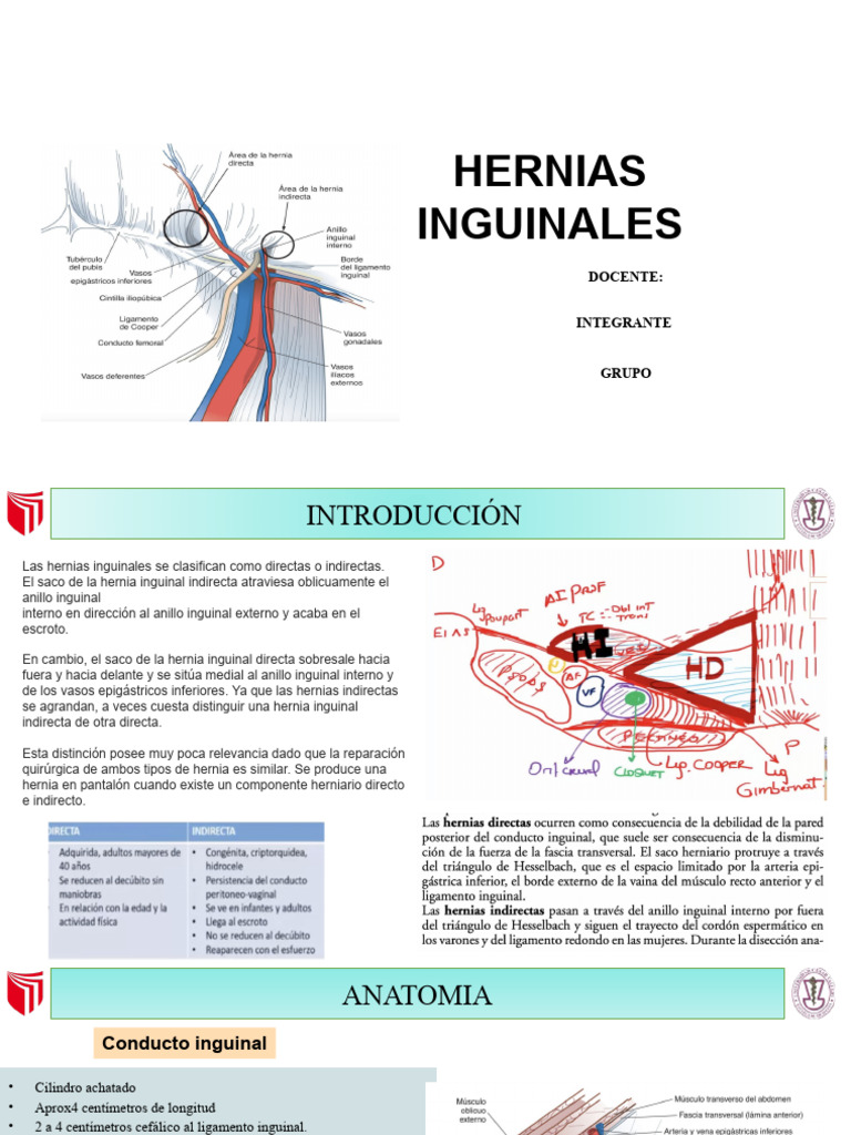 Clasificación y Tratamiento de Hernias Inguinales | PDF