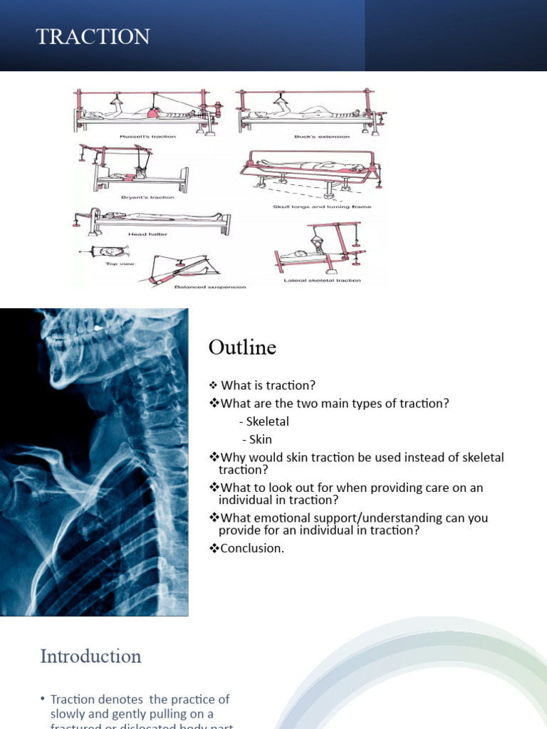 TRACTION | PDF | Bone | Skeletal Muscle