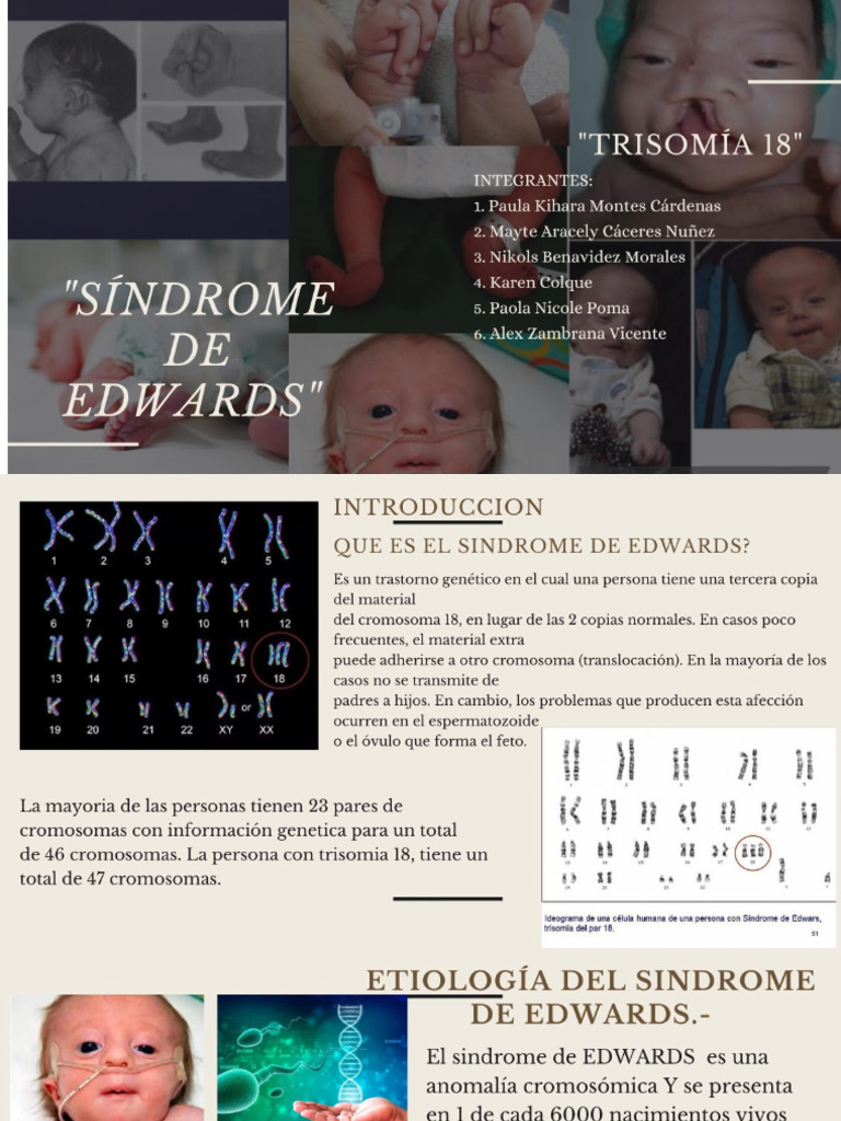 Síndrome de Edwards - Grupo 3 | PDF