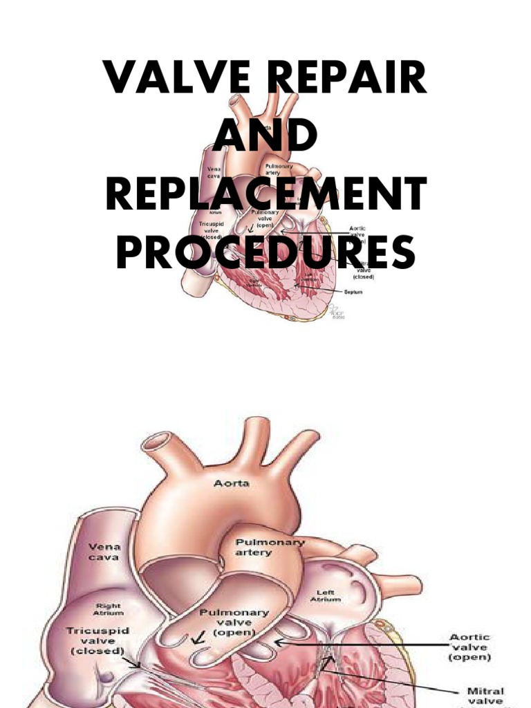 Cardiac Valve Surgery Guide | PDF | Heart Valve | Surgical Procedures
