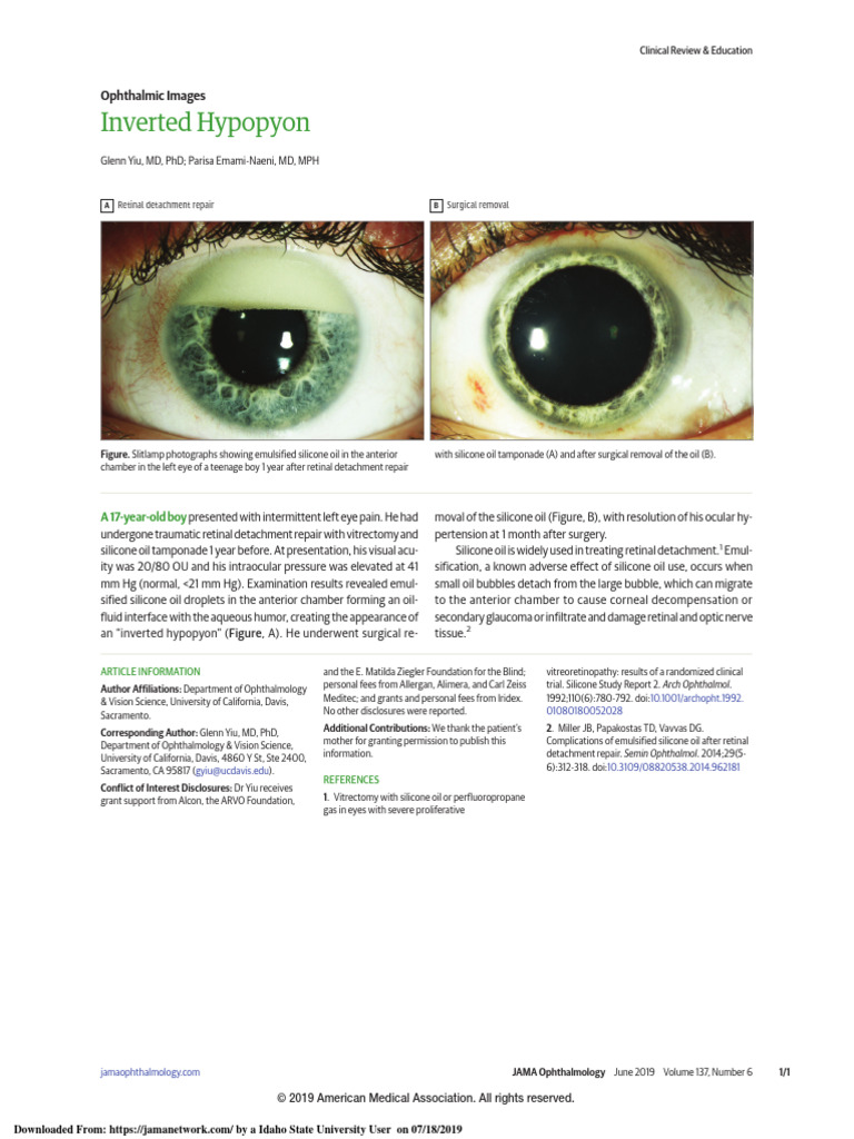 Inverted Hypopyon in Retinal Surgery | PDF
