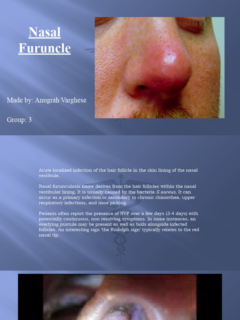 Nasal Furuncle | PDF