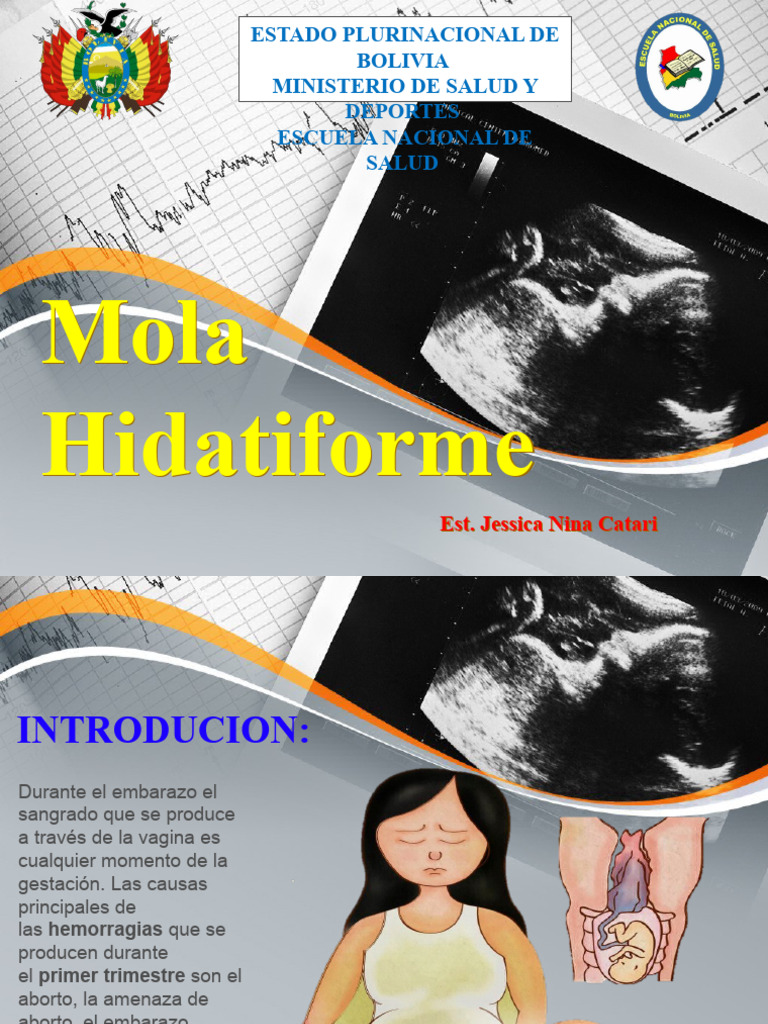 Mola Hidatiforme | PDF