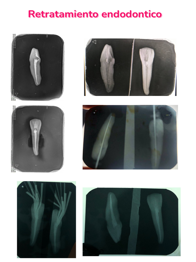 Retratamiento Endodontico | PDF