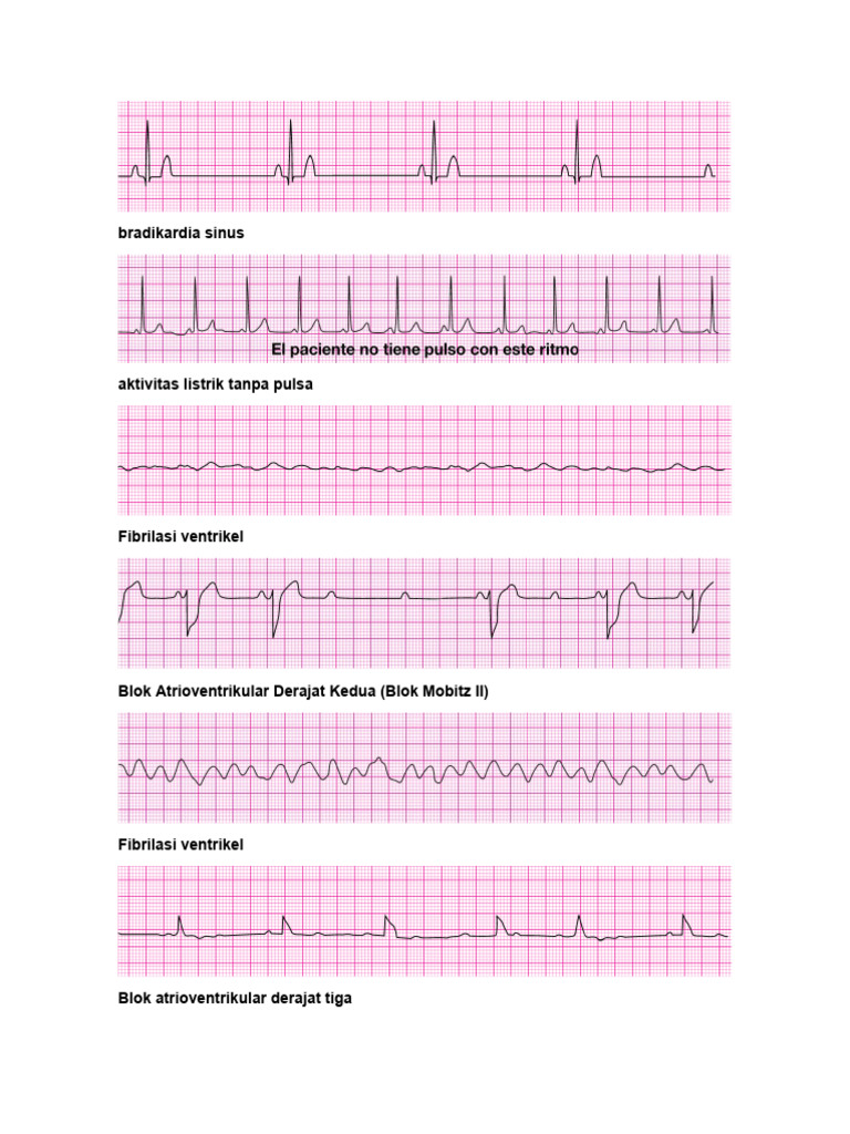 Ekg Acls | PDF