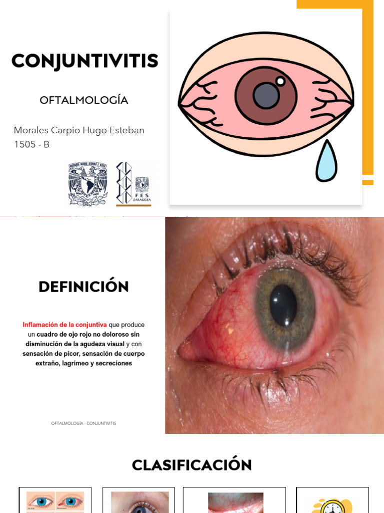 Conjuntivitis y Queratitis | PDF | Alergia | Herpes Simple