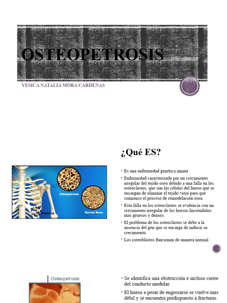 OSTEOPETROSIS | PDF | Hueso | Órgano (anatomía)