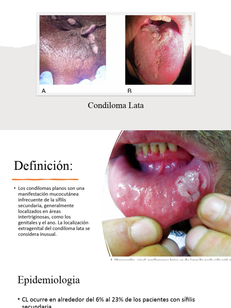 Condiloma Lata en Sífilis Secundaria | PDF | Enfermedades y trastornos ...