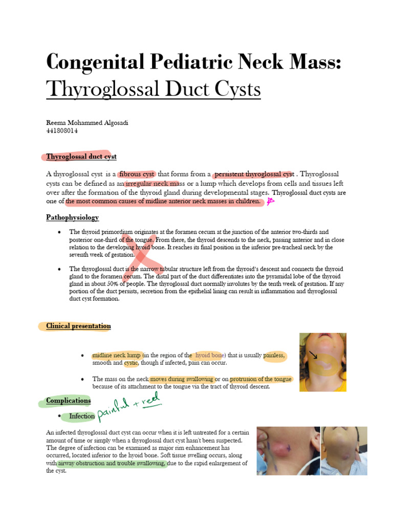 Thyroglossal Duct Cysts | PDF