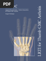 Mini Tightrope CMC Fixation | PDF | Thumb | Musculoskeletal System