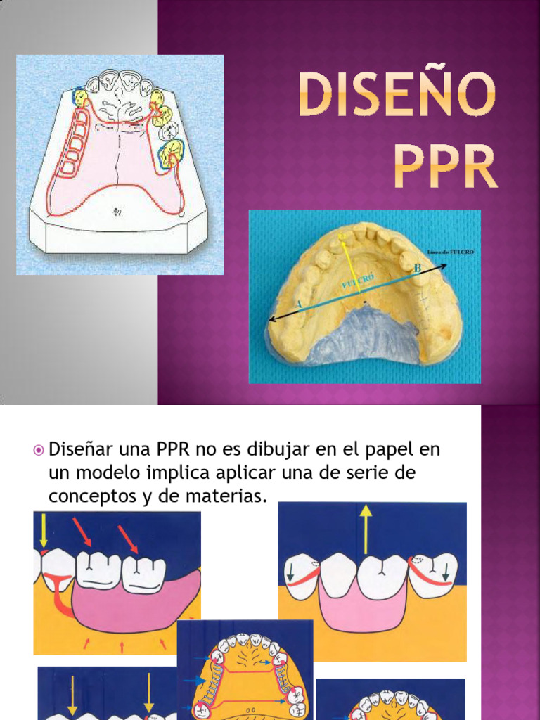 Diseno de PPR | Descargar gratis PDF | Anatomia dental | Ramas de ...