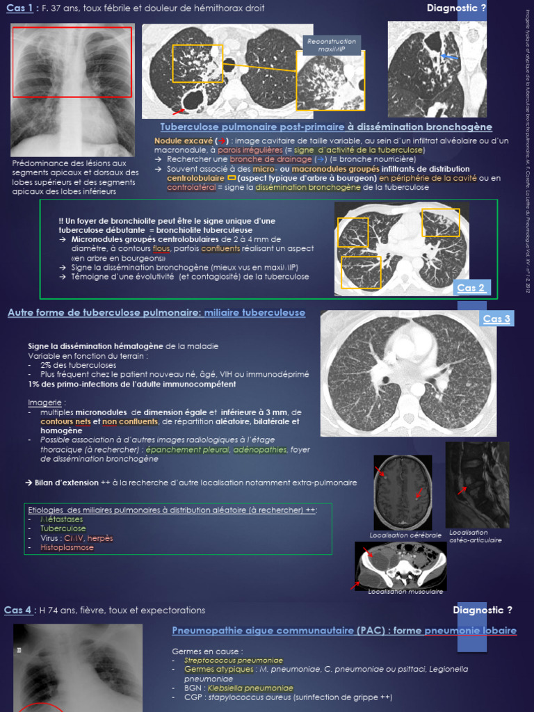 Pneumonie aiguë et tuberculose pulmonaire | PDF