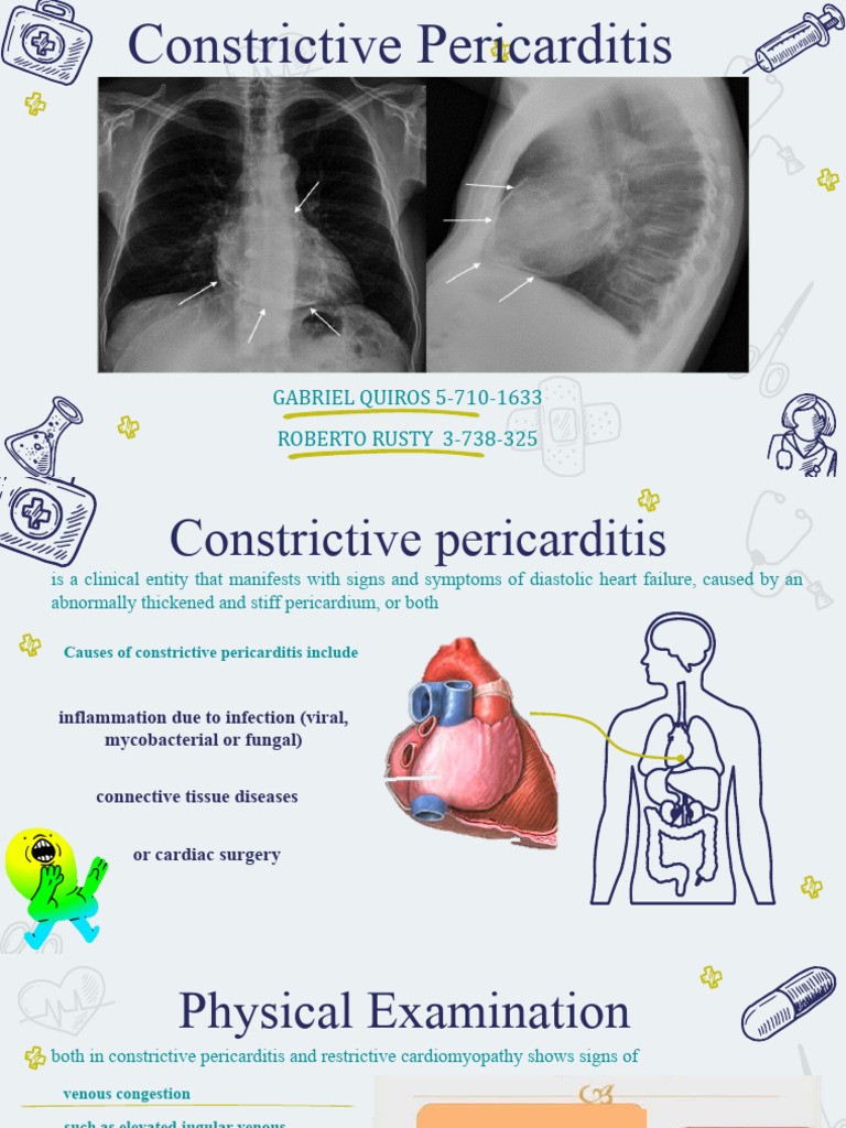 Pericarditis Constrictiva | PDF