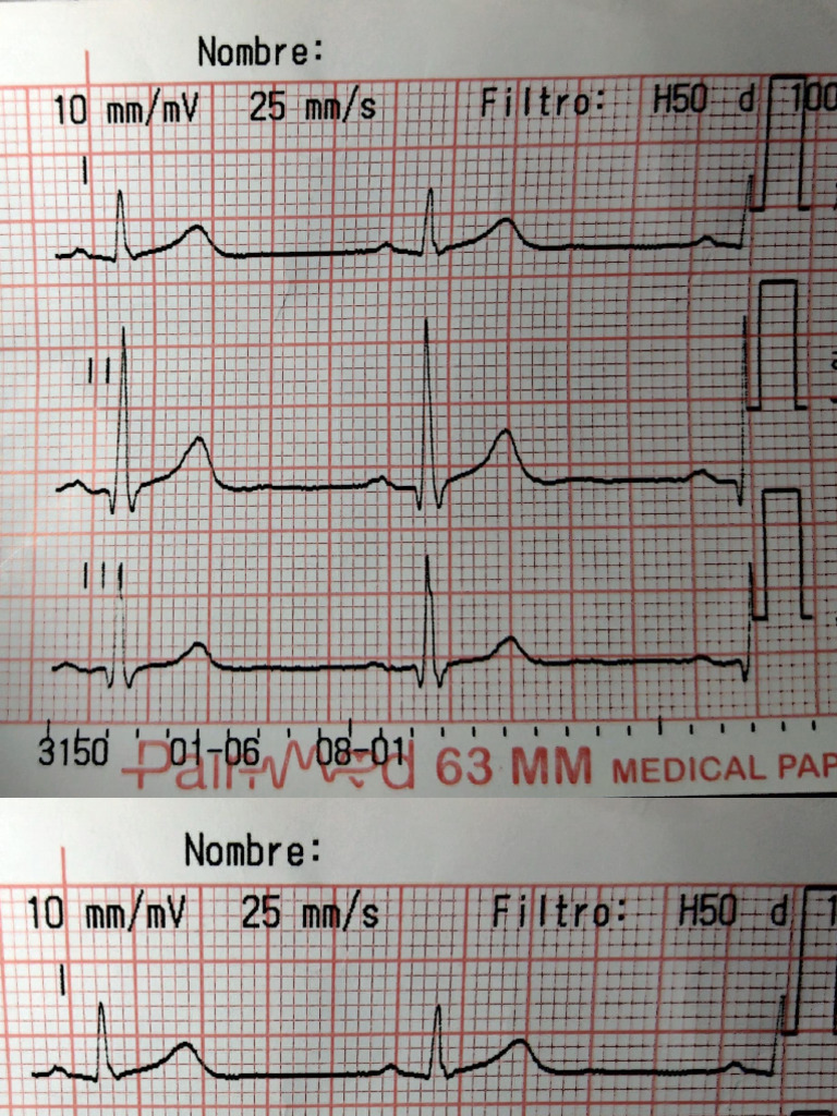 Electrocardiograma Normal | PDF