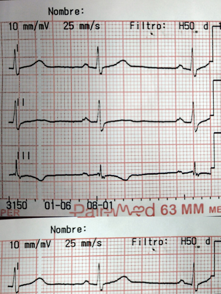 Trazo ordinario EKG | PDF