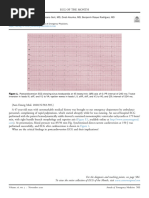 Sgarbossa Criteria - LITFL - ECG Library Diagnosis | PDF ...