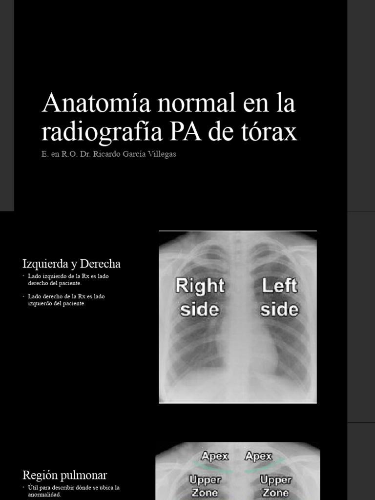 RX Tórax Normal y Patològica | PDF | Pulmón | Tórax