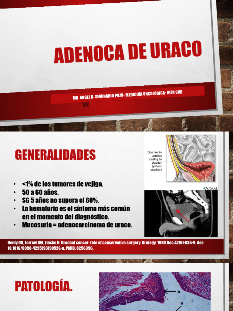 Adenoca de Uraco | PDF