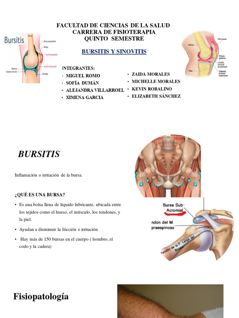 Sinovitis y Bursitis | PDF