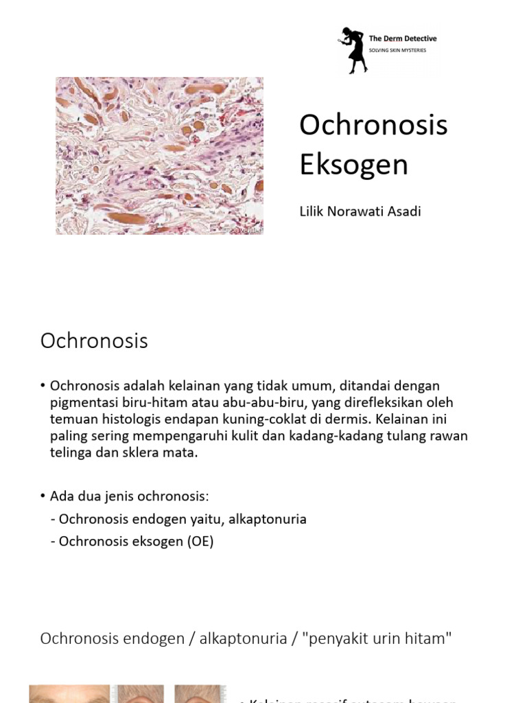 Ochronosis Eksogen: Penyebab dan Pengobatan | PDF | Sains & Matematika