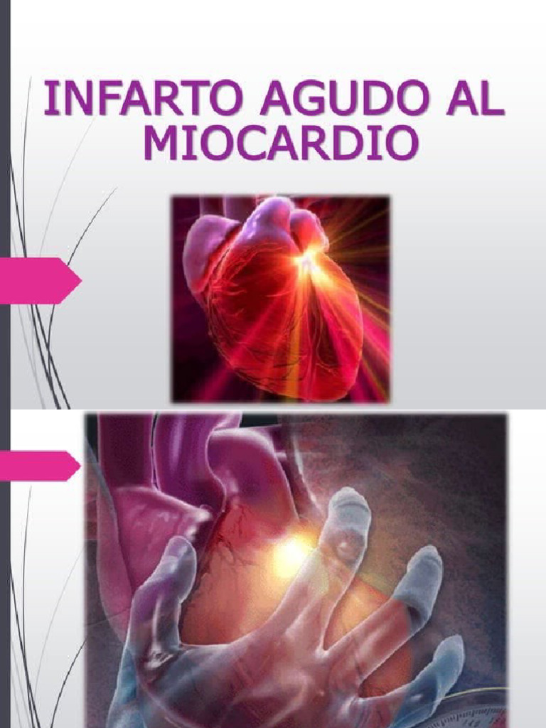 Infarto Agudo Del Miocardio | PDF