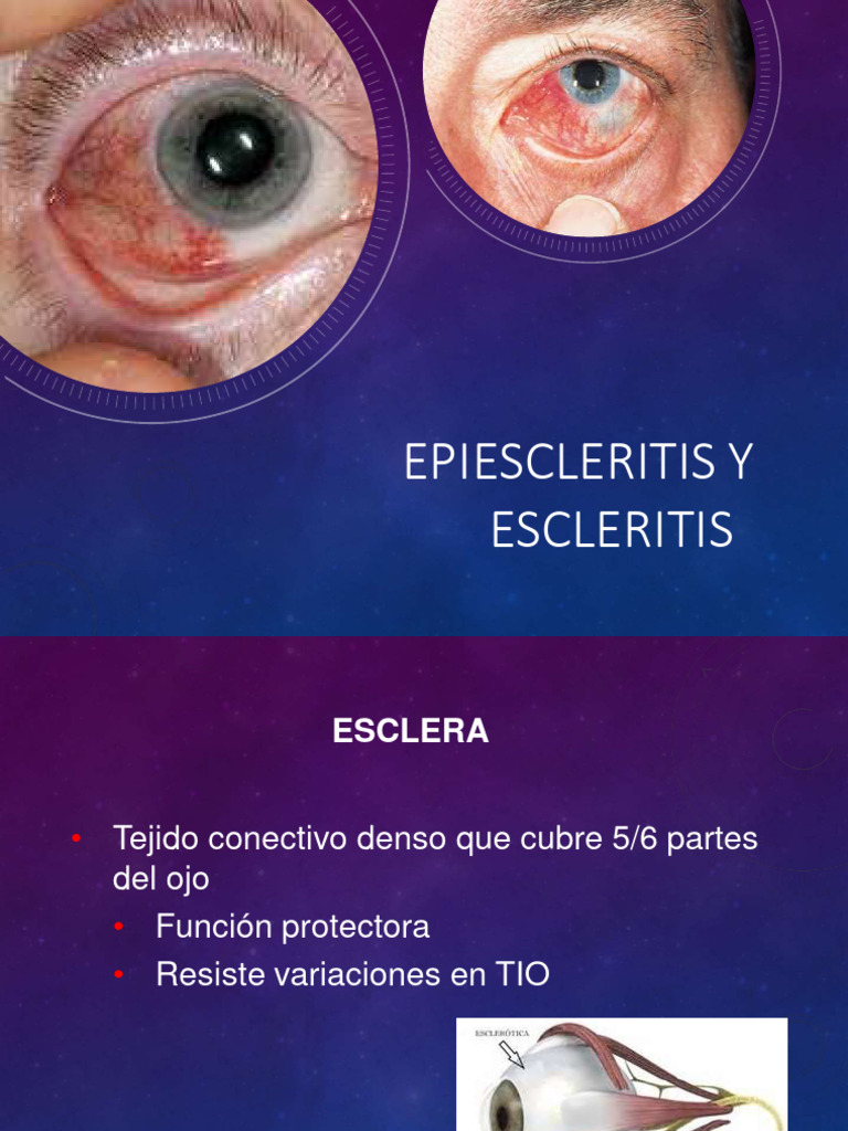 MATERIAL DE APOYO - UNIDAD V - Patologías de La Esclera | PDF | Salud ...