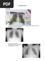 Patologías en RX | PDF | Pulmón | Tórax