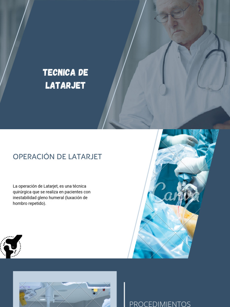 Operación de Latarjet: Técnica y Complicaciones | PDF