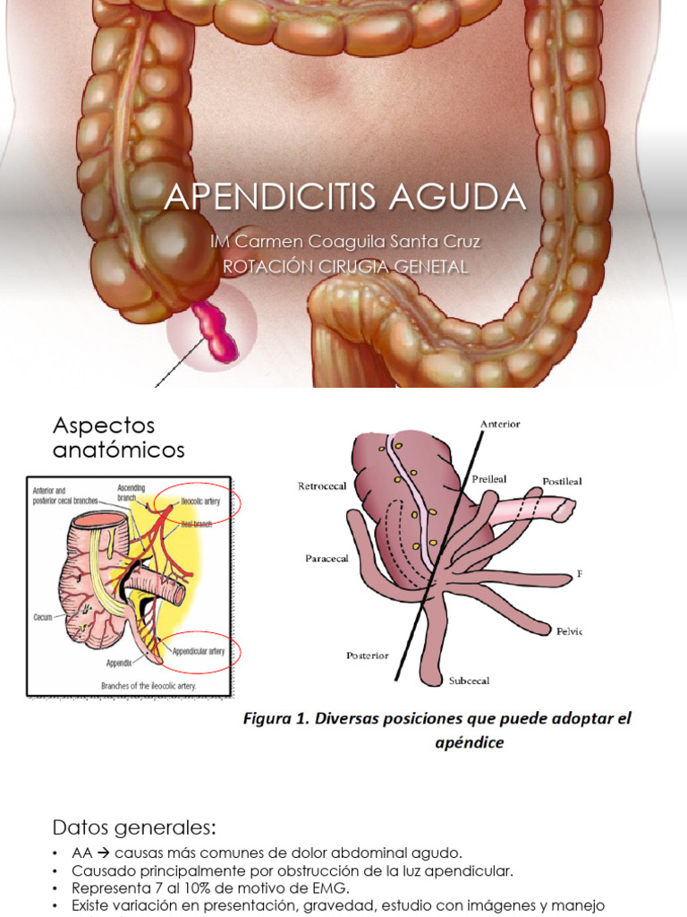 Apendicitis Aguda Ciru Expo R | PDF