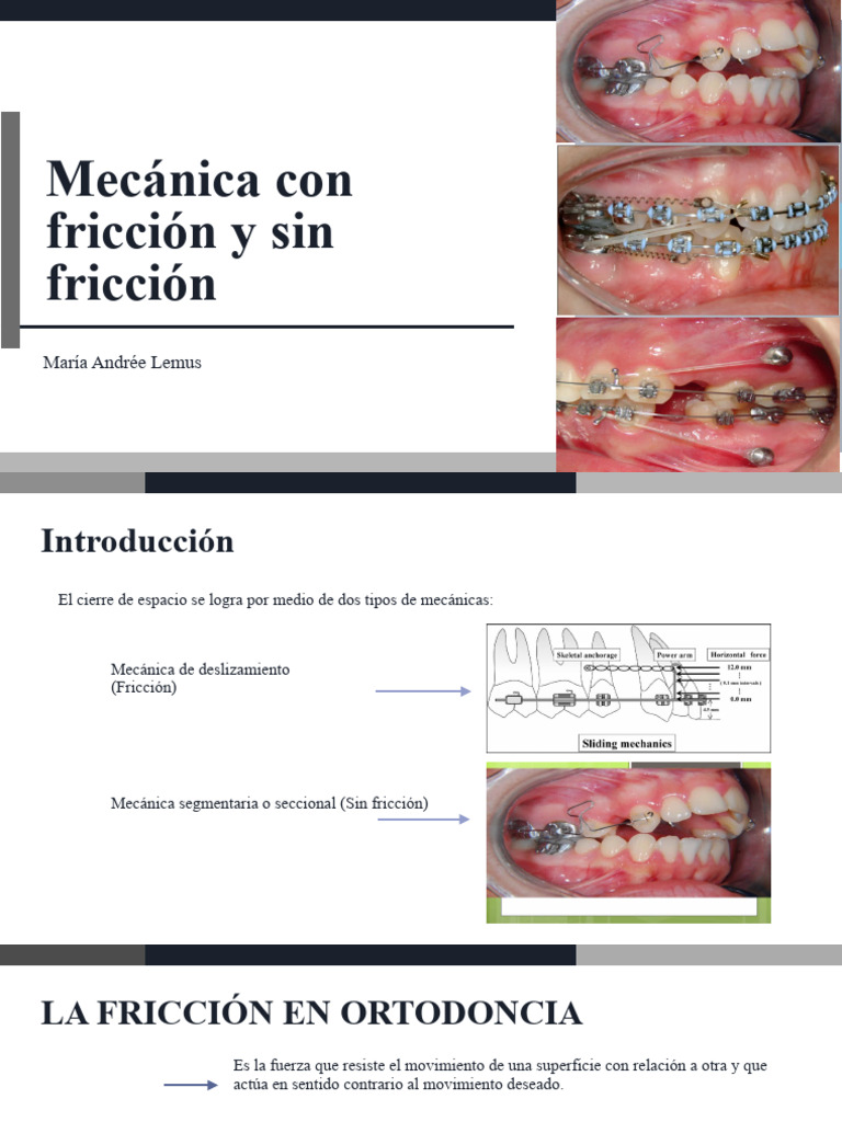 Mecánicas de Friccion y Sin Friccion | PDF | Ortodoncia | Ingeniería ...