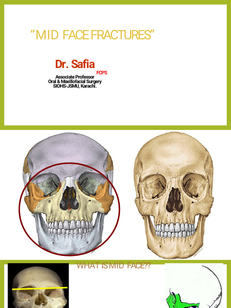 Mid Face Fracture JSMU | PDF | Musculoskeletal System | Skeletal System
