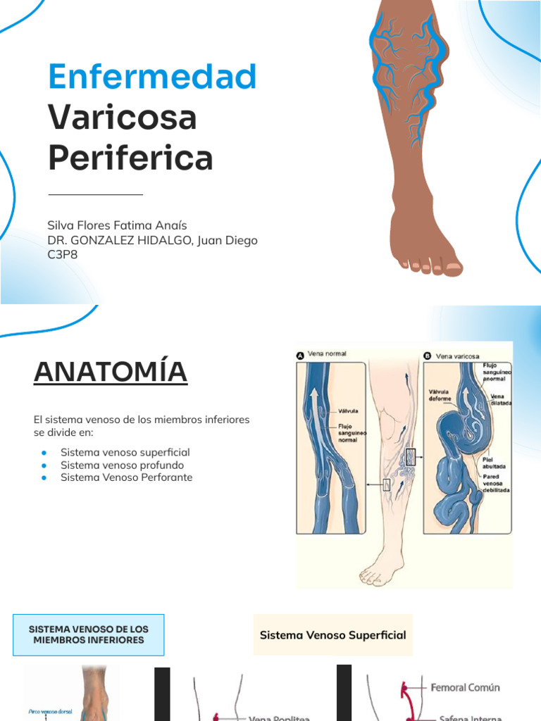 Clasificación y Tratamiento de Varices | PDF | Venas varicosas | Medicina