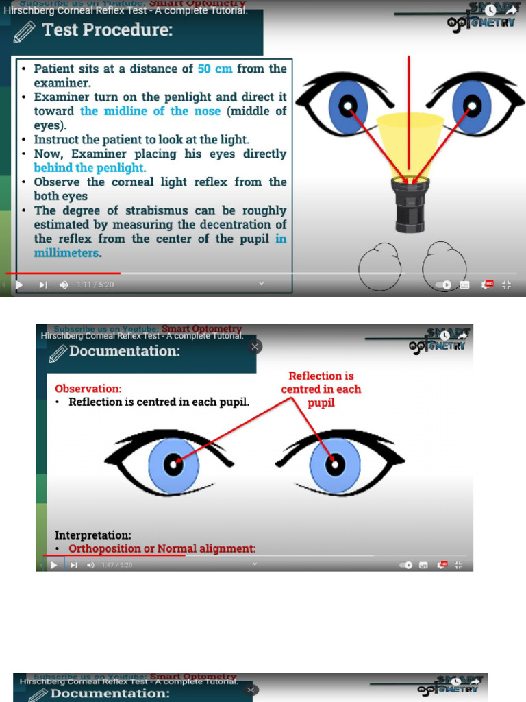 Hirschberg's Test | PDF