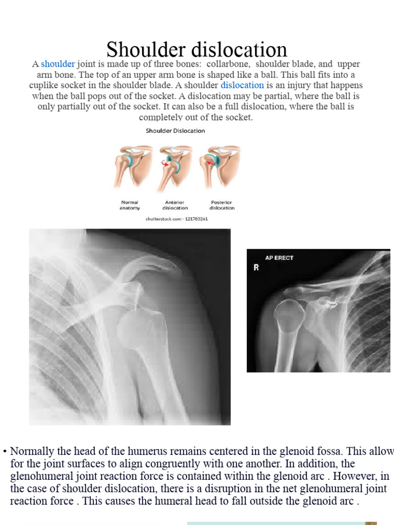 Shoulder Dislocation | PDF | Shoulder | Anatomical Terms Of Motion