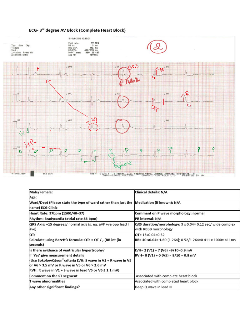 ECG - Complete Heart Block | PDF | Electrocardiography | Cardiovascular ...