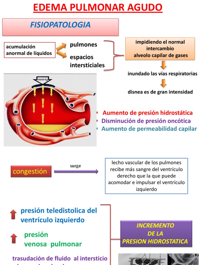 Fisiopatologia Edema Pulmonar Agudo | Edema | Pulmón