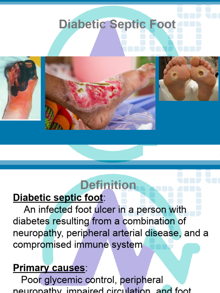 Diabetic Foot Ulcer Management Guide | PDF | Peripheral Neuropathy ...