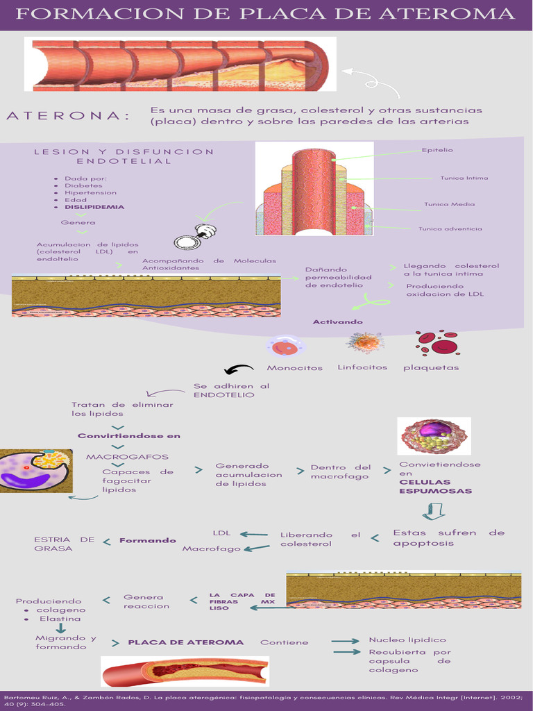 Formacion de Placa de Ateroma | PDF | Ateroma | Macrófago