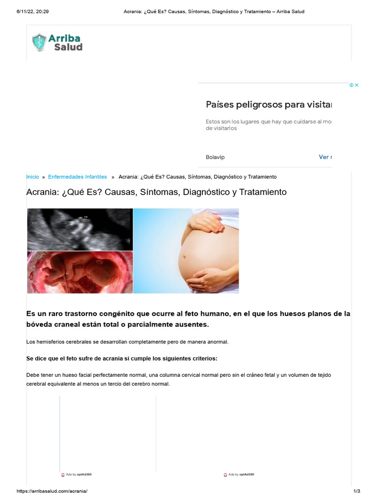 Acrania_ ¿Qué Es_ Causas, Síntomas, Diagnóstico y Tratamiento – Arriba ...