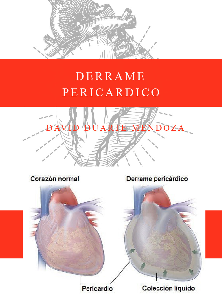 Derrame Pericardico y Taponamiento | PDF | Tórax (anatomía humana ...