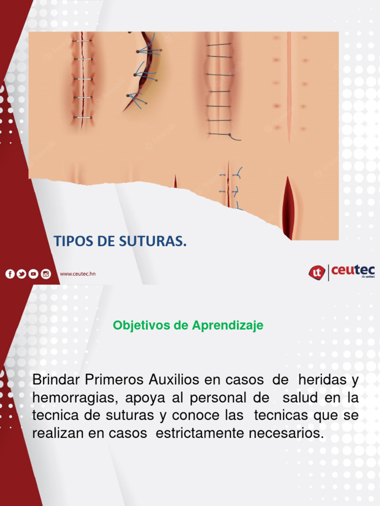 Presentación # 8 Tipo de Suturas | Descargar gratis PDF | Herida | Sutura Quirúrgica