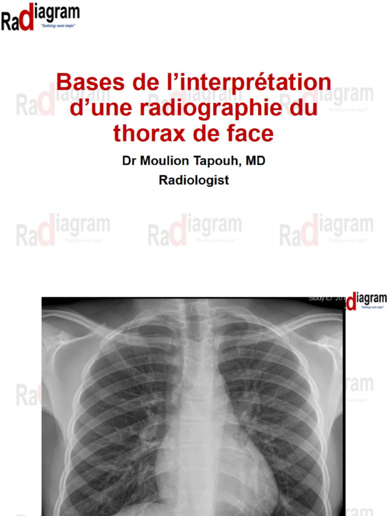 Bases Interpretation RX Thorax | PDF