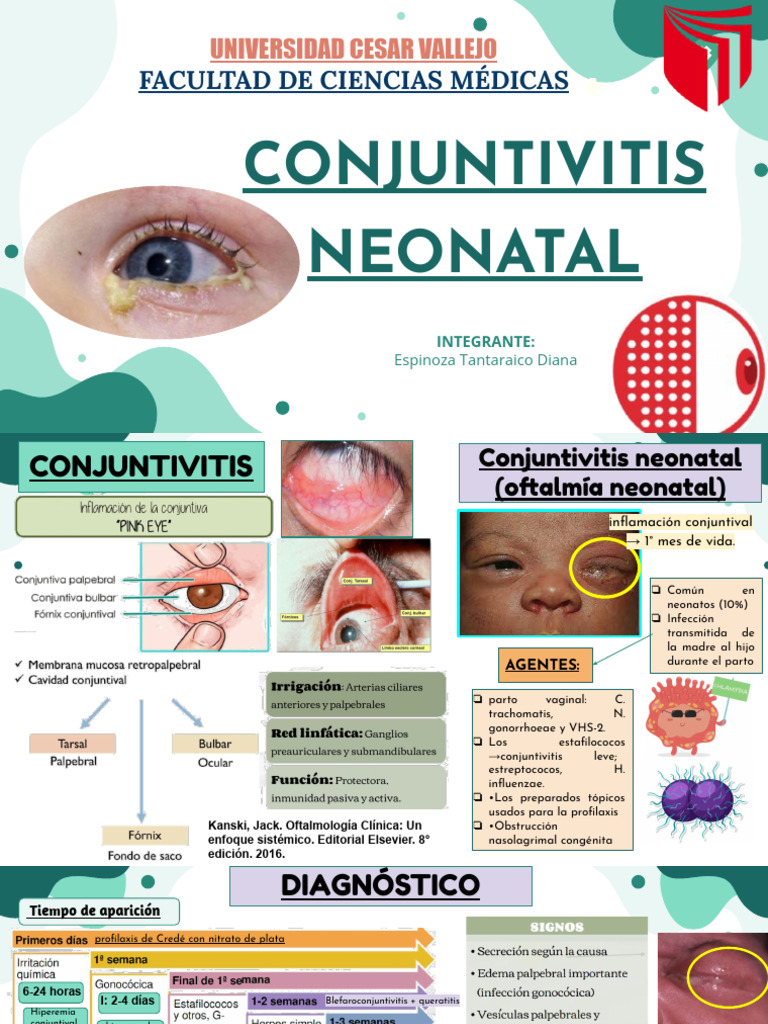 Conjuntivitis Neonatal: Diagnóstico y Tratamiento | PDF | Oftalmología ...