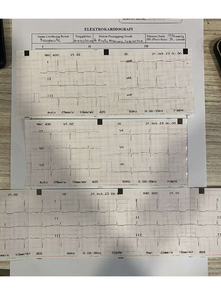 Contoh Ekg | PDF