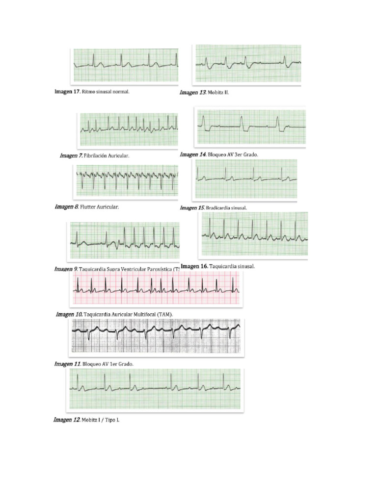 EKG | PDF
