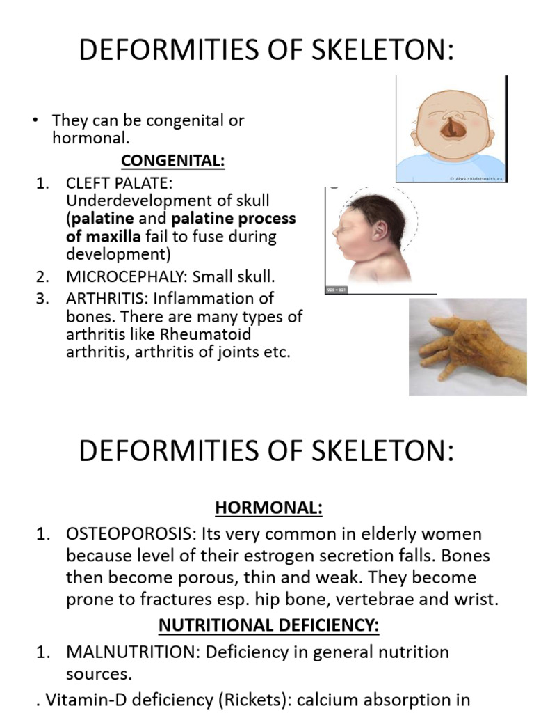 Deformities of Skeleton | PDF | Bone | Medical Specialties